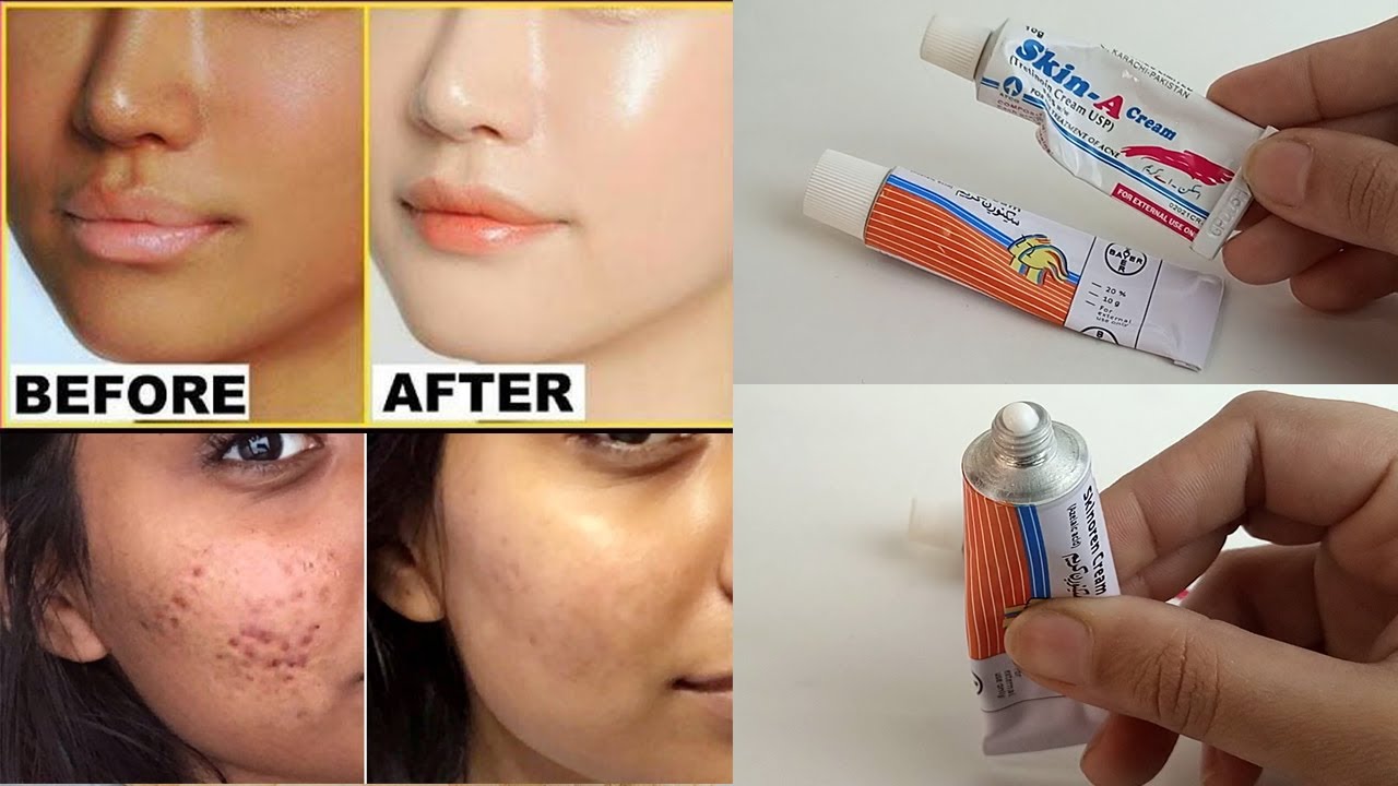 Can we use skinoren cream and skin a cream together | Azelaic acid ...