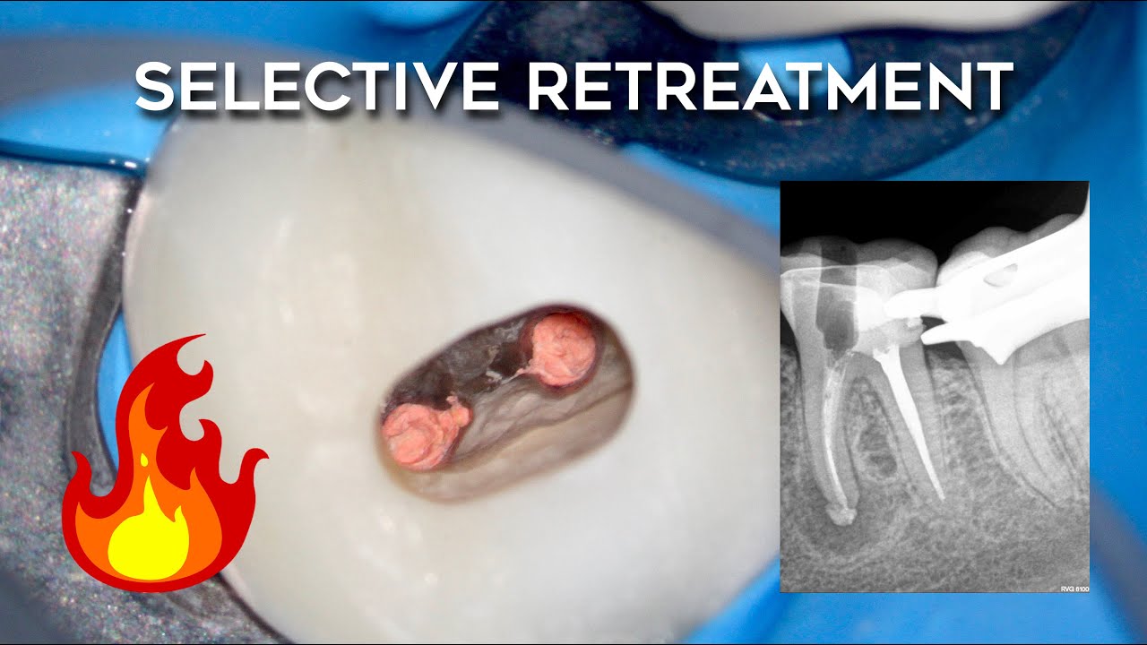 SELECTIVE RETREATMENT in a lower molar with apical periodontitis only ...