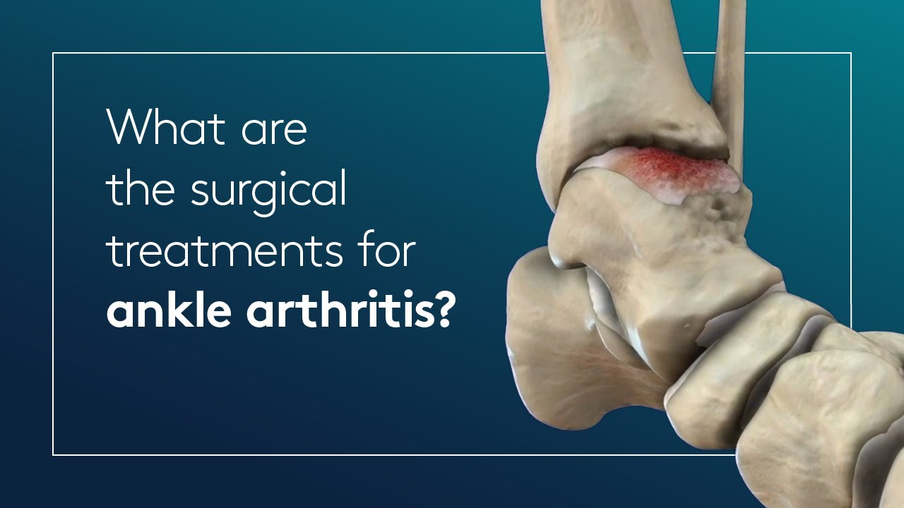 What Are The Surgical Treatments For Ankle Arthritis YouTube