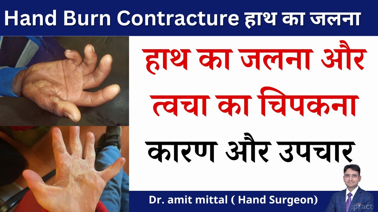 हाथ का जलना और त्वचा का चिपकना कारण और उपचार | Hand Burn Contracture in ...
