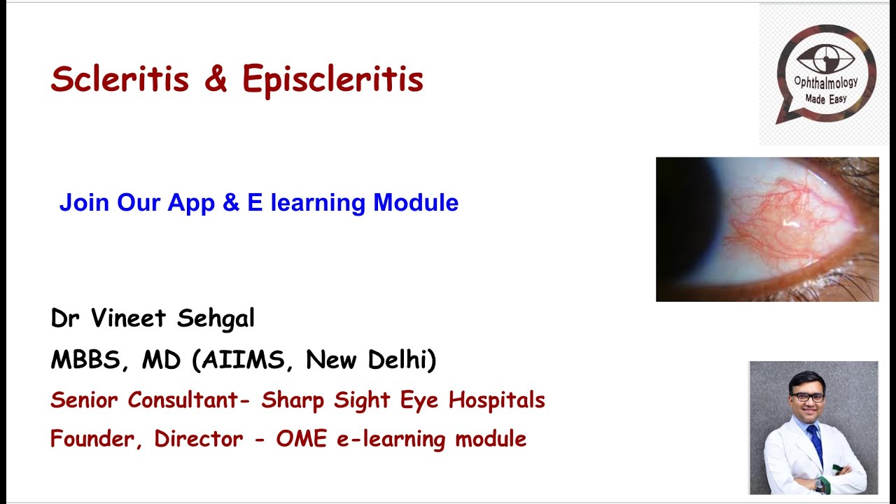 Scleritis & Episcleritis II Causes- Red Eye - YouTube