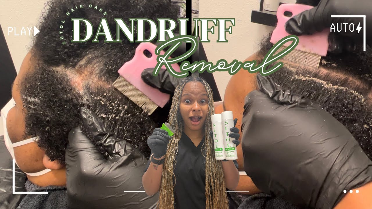 Shocking Dandruff Flakes | Big Flakes - YouTube