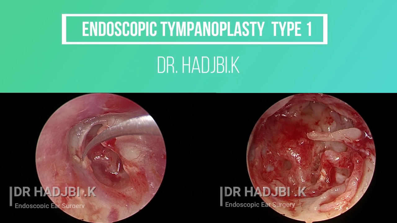 myringoplastie endoscopique - endoscopic myringoplasty ...