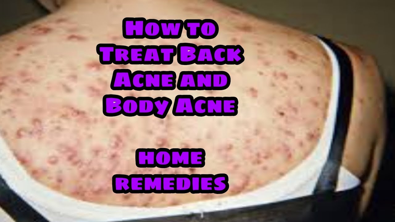 पीठ के पिम्पल्स कैसे हटाये? | Acne/Pimples on back | back acne home ...