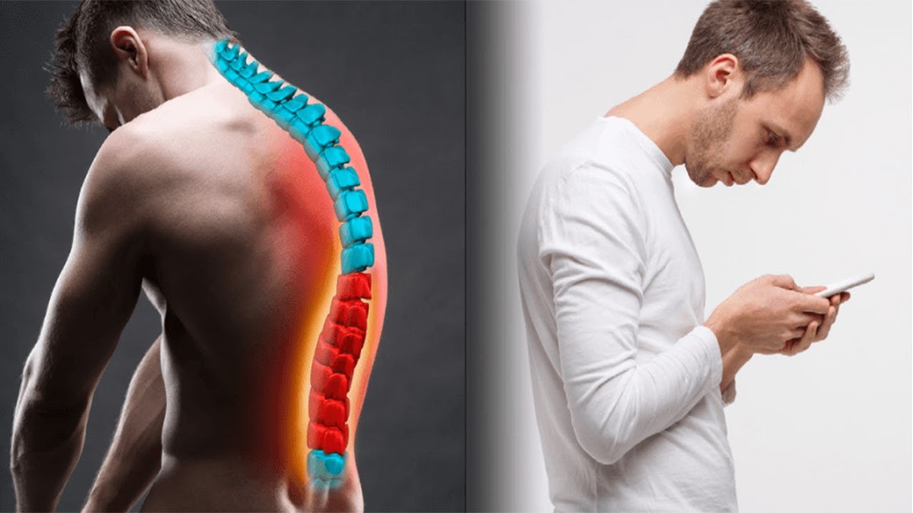 Kyphosis Symptoms Types Causes Treatment And Exercises Youtube