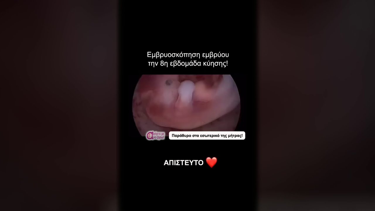 Εμβρυοσκόπηση εμβρύου την 8η εβδομάδα κύησης! - YouTube
