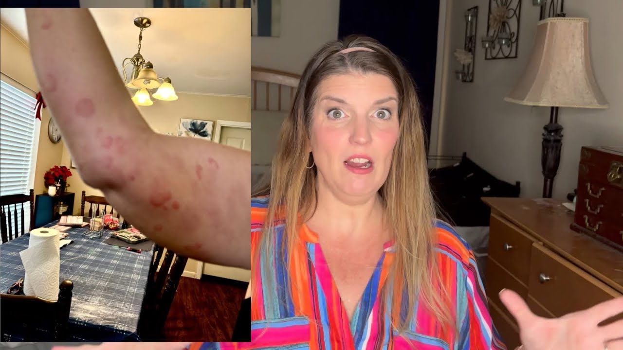 Allergic reaction to seizure medication!!! - YouTube