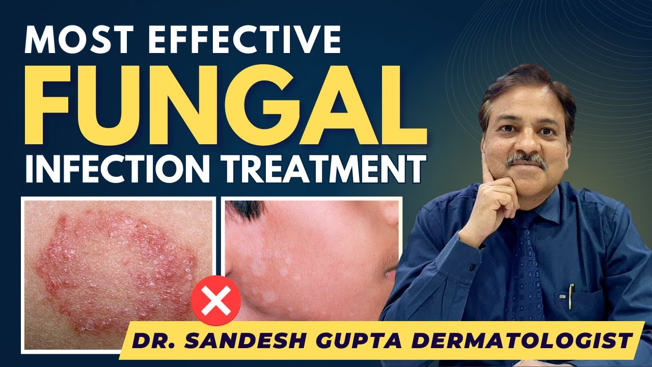 Effective Fungal Infection Treatment By Dermatologist || Dr SANDESH ...