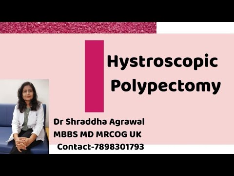 Hysteroscopic polypectomy - YouTube