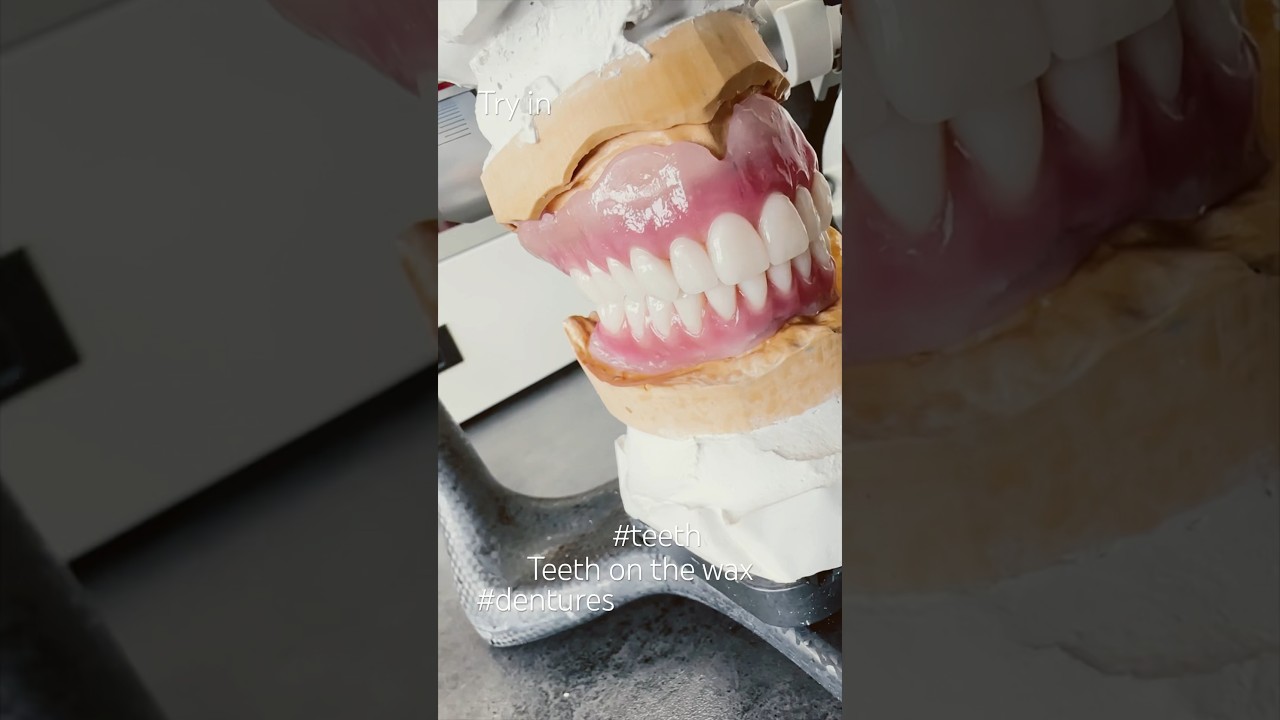 Try in, Teeth on the WAX, Dentures #dentures #smile #teeth #dentistry ...