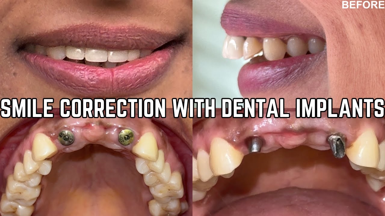 Overlapping Front Teeth Inman Aligner | Hopewell Junction, NY | Edward