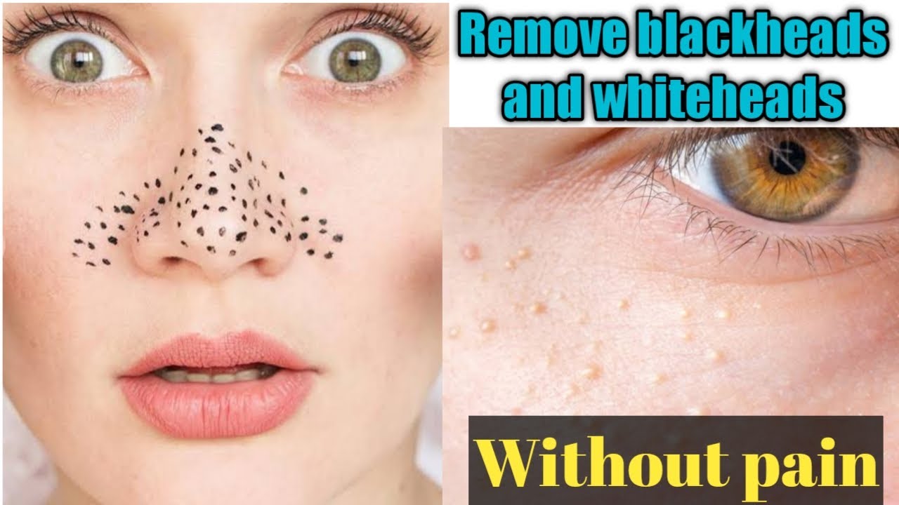 How To Remove Blackheads And Whiteheads Naturally At Home Without Pain how-to-remove-blackheads-and-whiteheads-naturally-at-home-without-pain