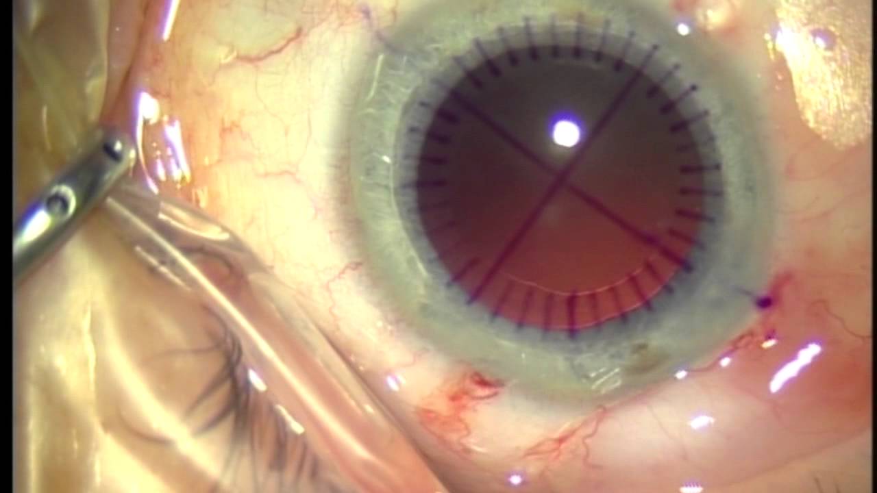 What is the TECNIS® multifocal 1 Piece IOL - Live surgery with Peter ...