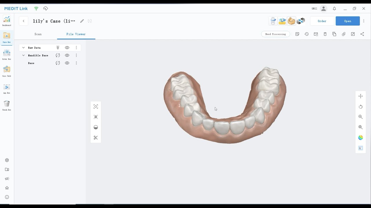 Medit link X UNIZ Dental Workflow - YouTube