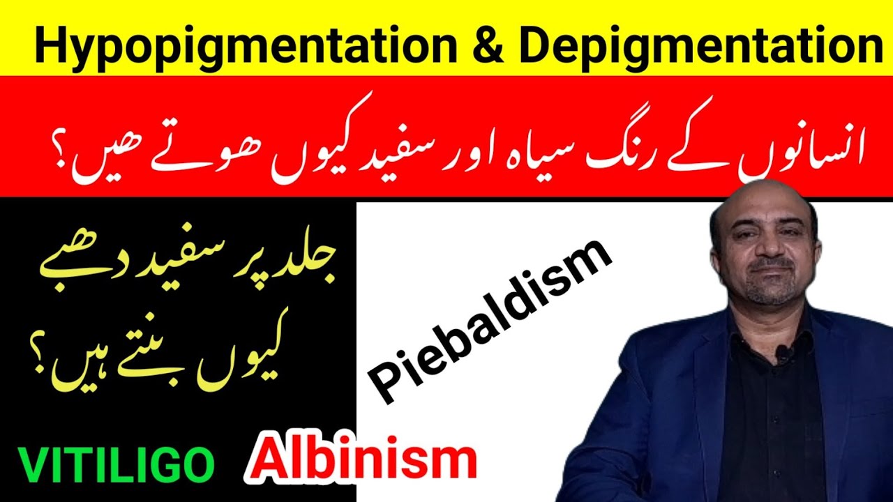What Is Hypopigmentation & Depigmentation? || What Role Melanin Plays ...