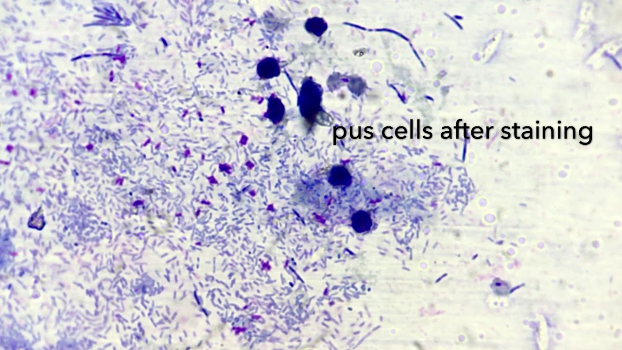 Pus Cells Appearance In Sediment And After Staining YouTube pus-cells-appearance-in-sediment-and-after-staining-youtube
