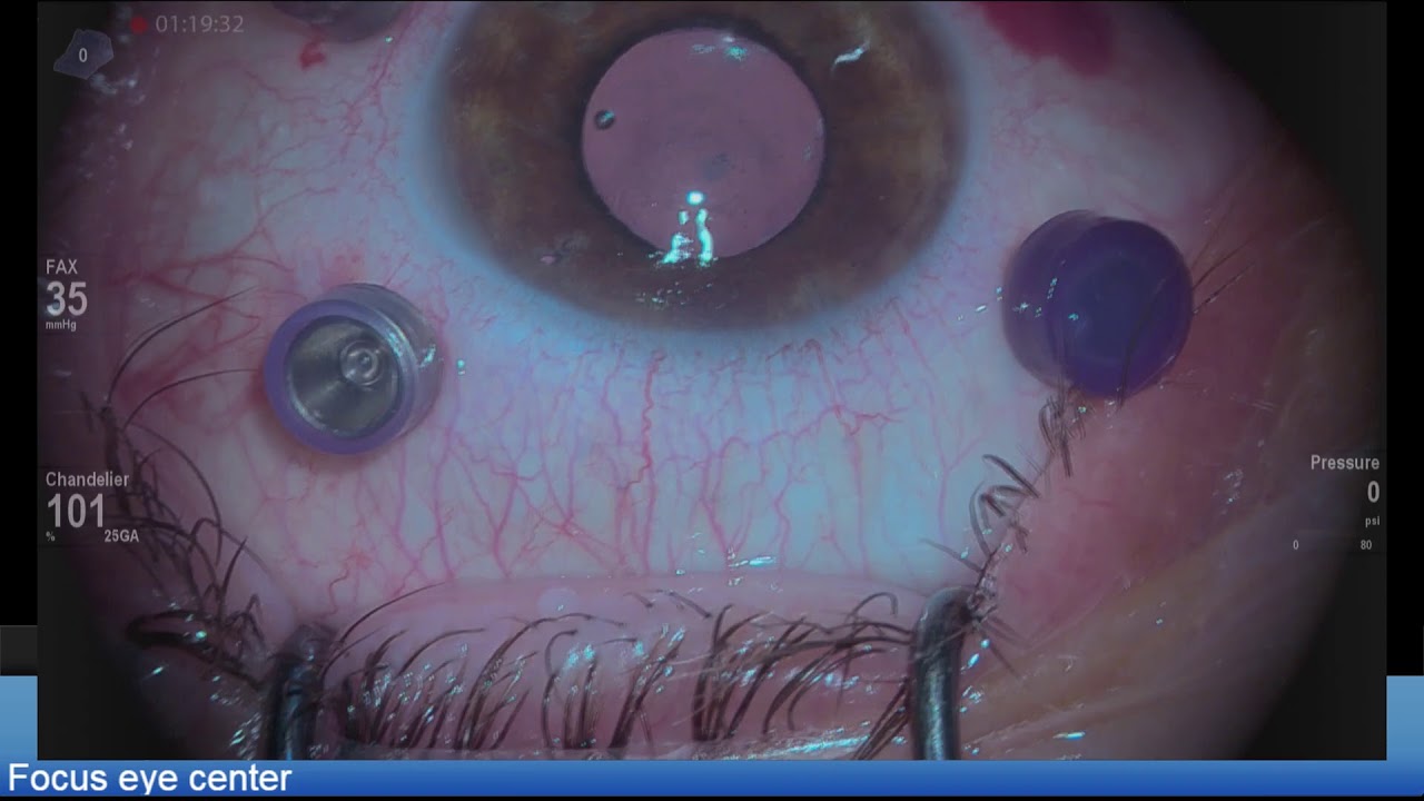 Re-ppv due to subretinal PVR Lukan Mishev Live Stream - YouTube