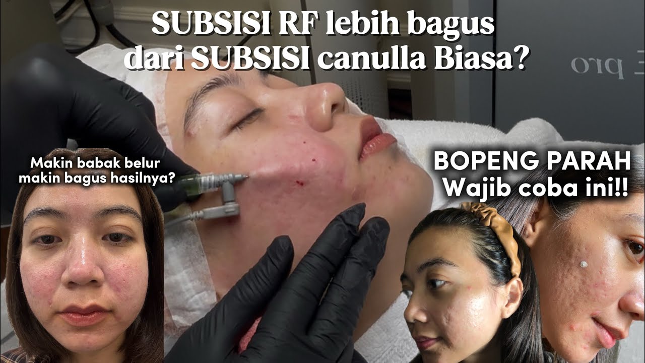 Part 1 - Subsisi RF buat bopeng parah & dalem | Subsisi RF lebih bagus ...