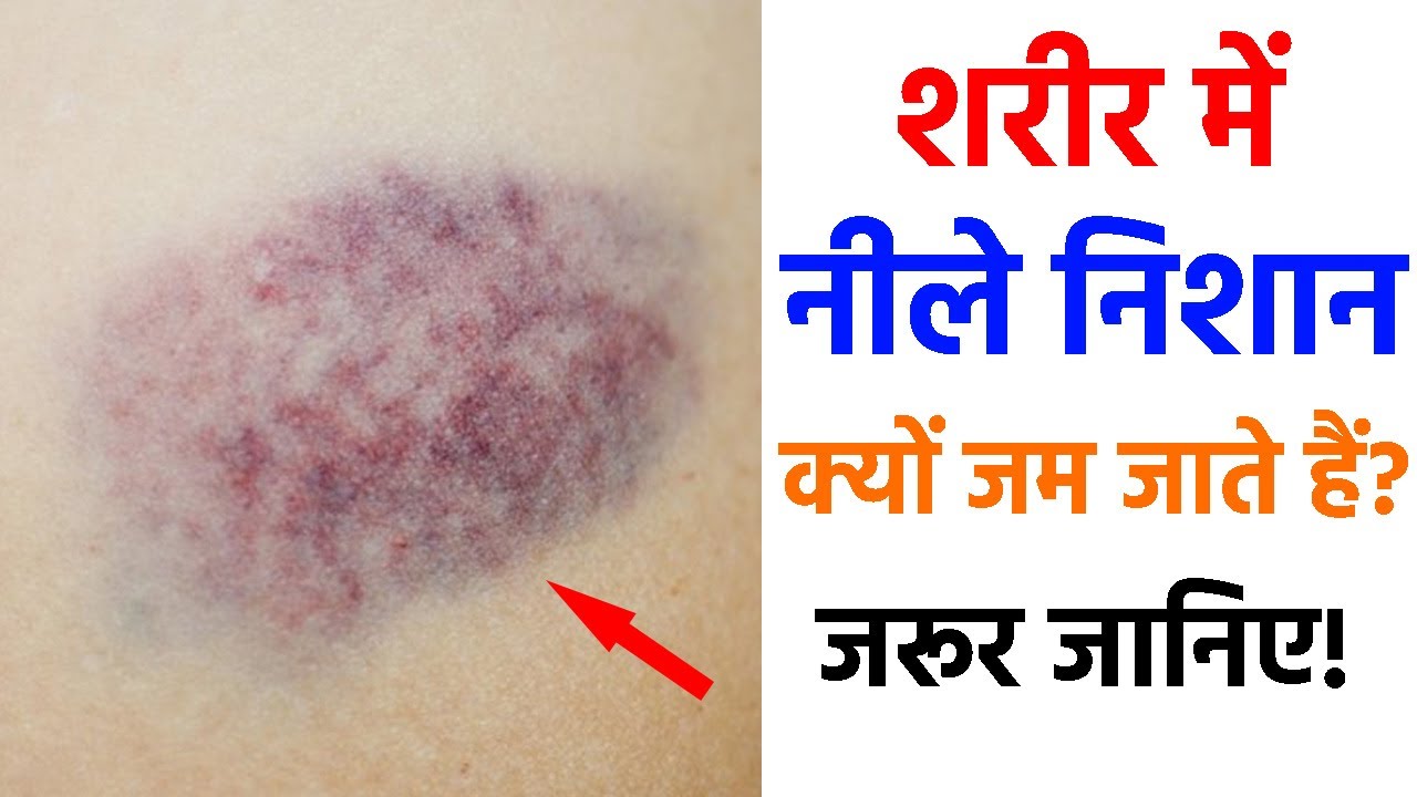 शरीर पर नीले निशान क्यों पड़ जाते हैं? Why We See Blue Bruise In Our ...