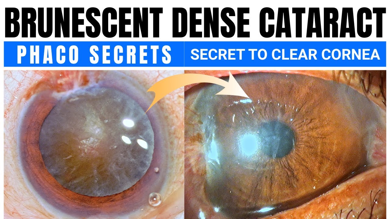 Brunescent dense cataract, Phaco strategies :- Dr. Deepak Megur - YouTube