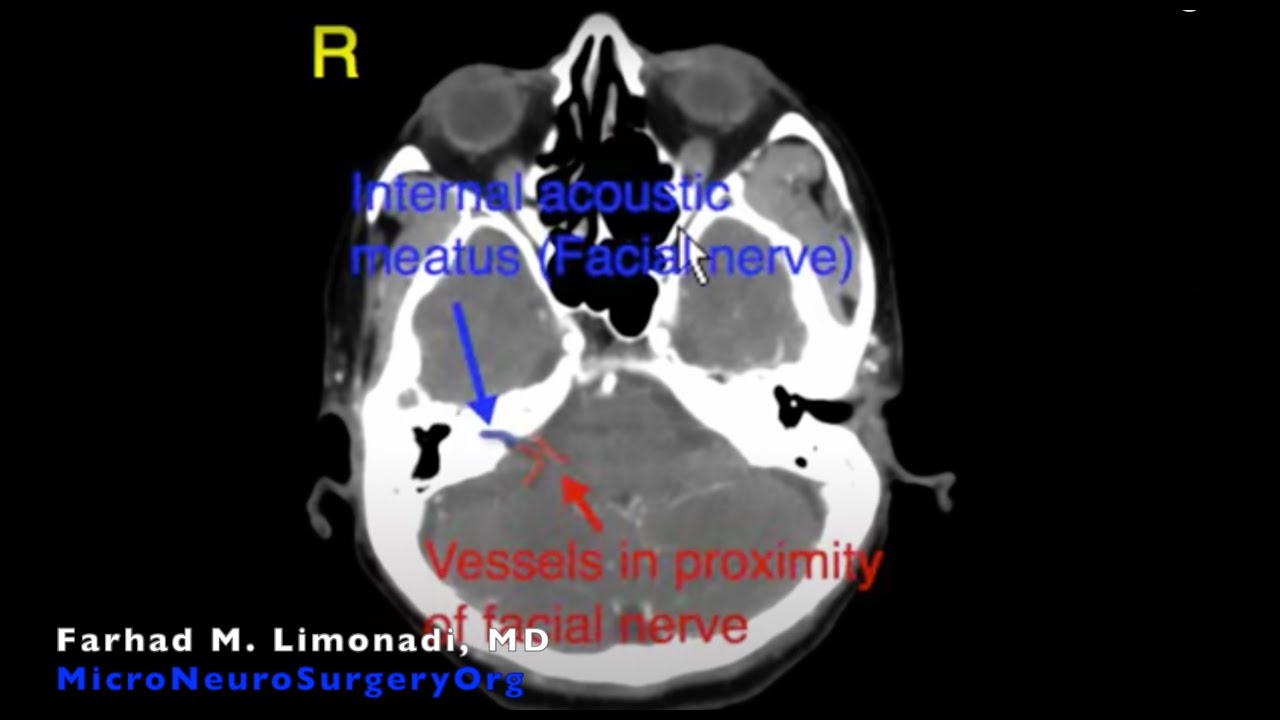 Brain Surgery: Microvascular Decompression of facial nerve for ...