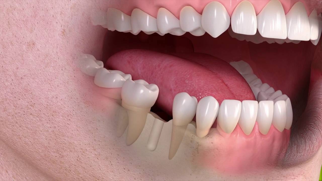 Single tooth replacement with a dental implant - YouTube