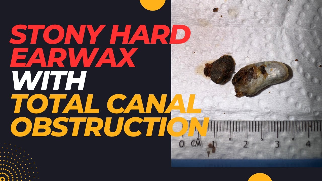 Stony HARD Earwax With TOTAL Canal Obstruction - YouTube