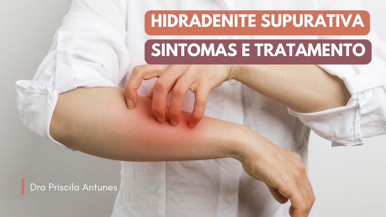Hidradenite Supurativa ‐ Seus sintomas e Tratamento Part. Dr Guilherme ...