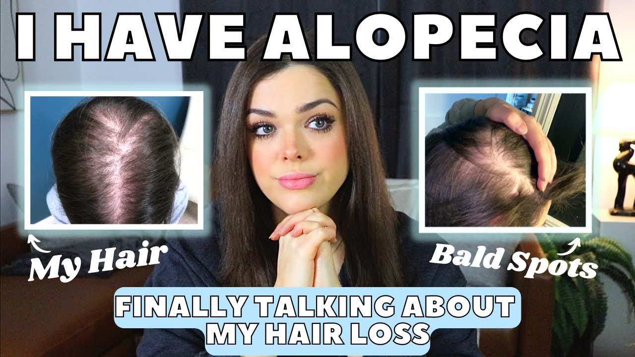 I Have Alopecia | Going Bald As a Woman | My Story With Pictures - YouTube