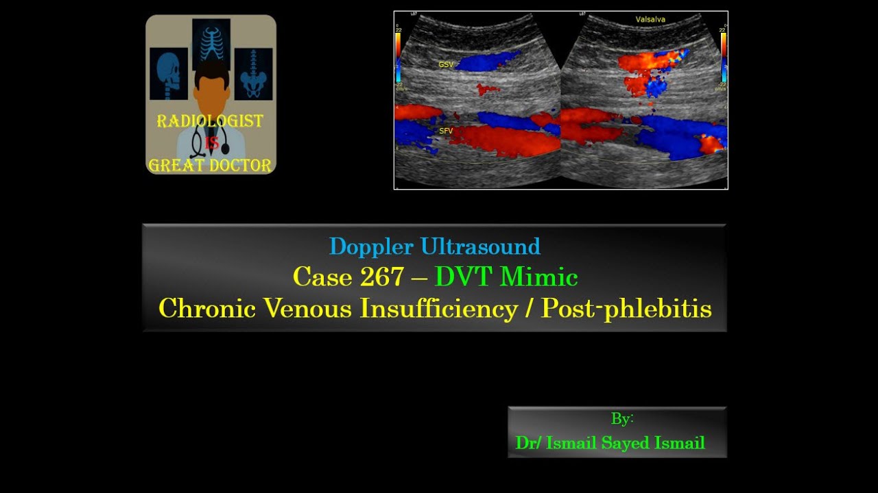 Ultrasound Case 267 - DVT mimic (Chronic Venous Insufficiency) - YouTube