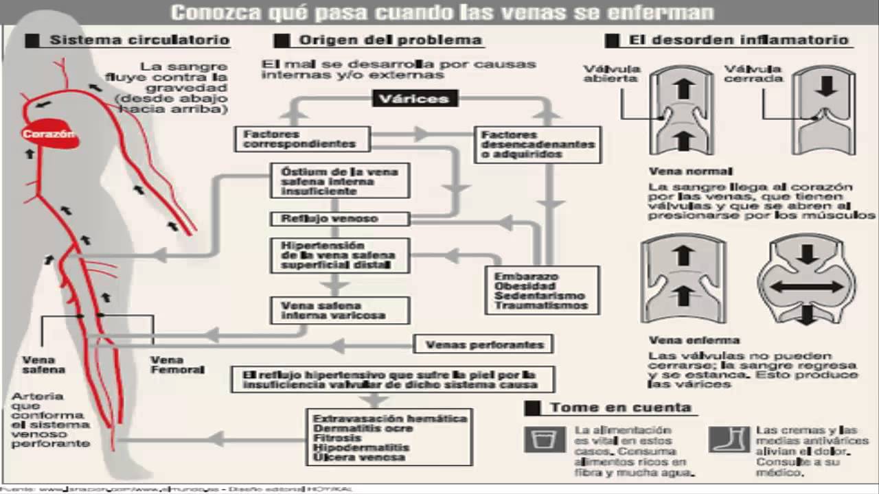 Cuales Son Los Sintomas De Varices Internas En Las Piernas 1 - YouTube