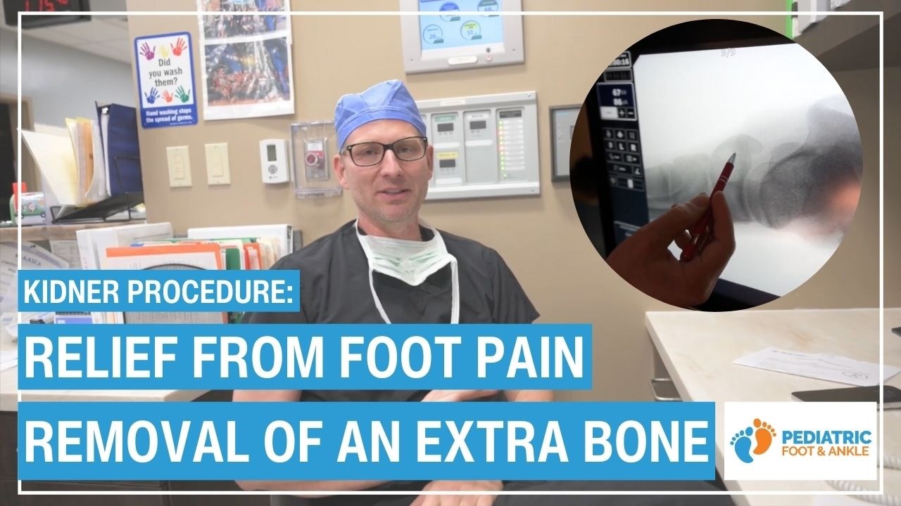 Kidner Procedure: Relief from Foot Pain by Removing the Accessory ...