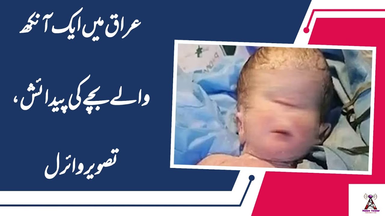 One-eyed baby born in Iraq, photo goes viral | عراق میں ایک آنکھ والے ...