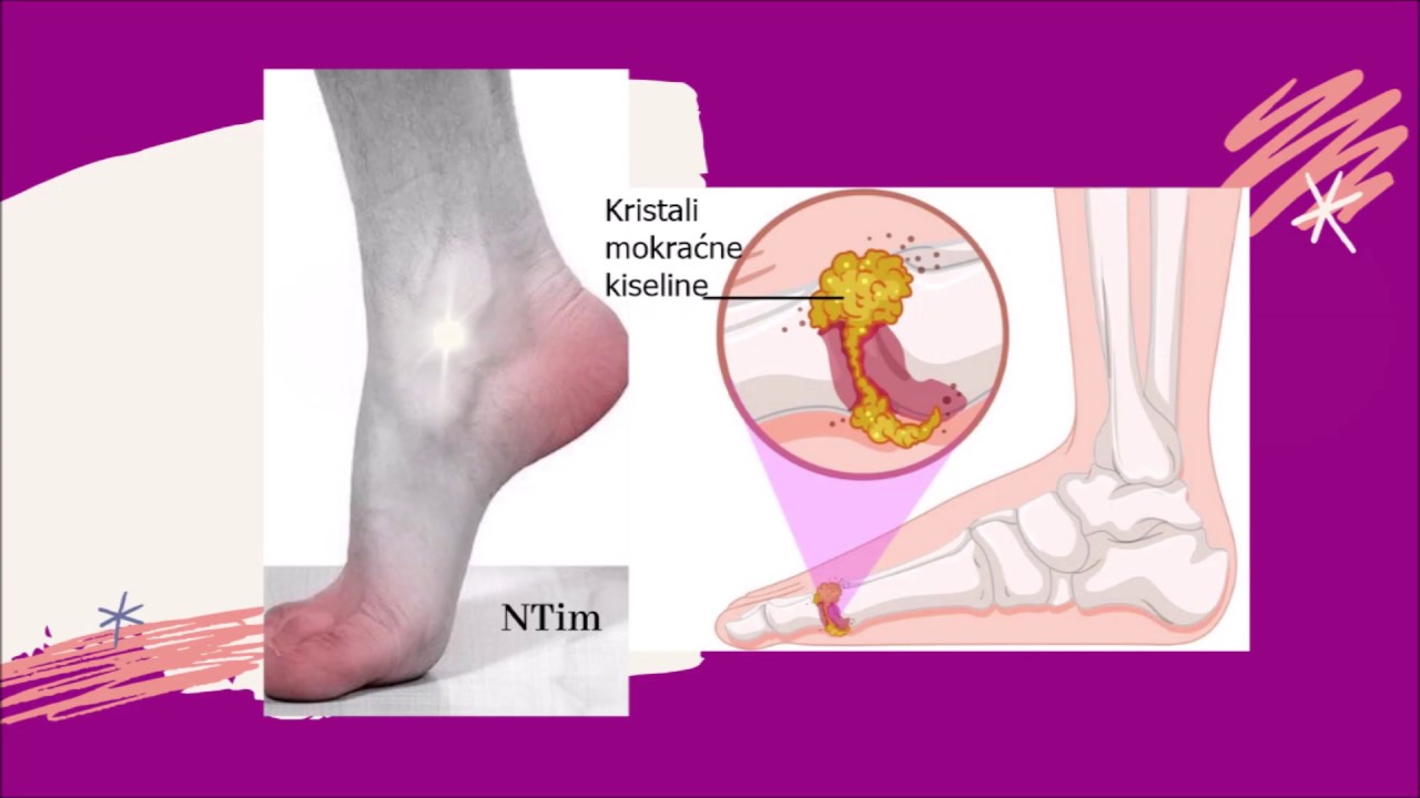 GIHT 1.dio (što je giht, uzroci i posljedice) - YouTube