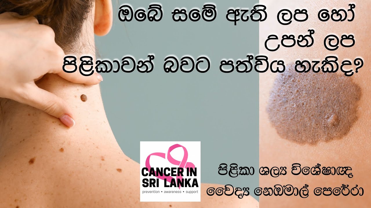 ඔබේ සමේ ඇති ලප හෝ උපන්ලප පිළිකා විය හැකිද. Can birth marks or black ...