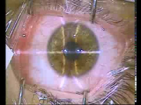 trans PRK surgery - YouTube