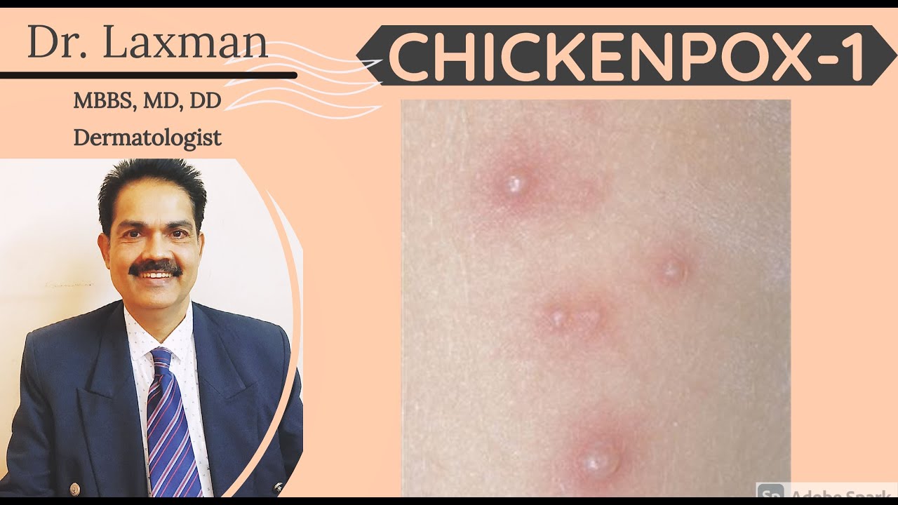 Chickenpox-Causes & Symptoms | Chickenpox-1 | Varicella | Features Of ...
