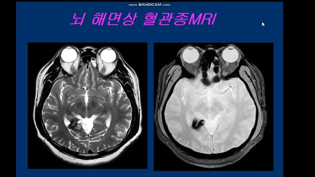 뇌 해면상 혈관종MRI - YouTube