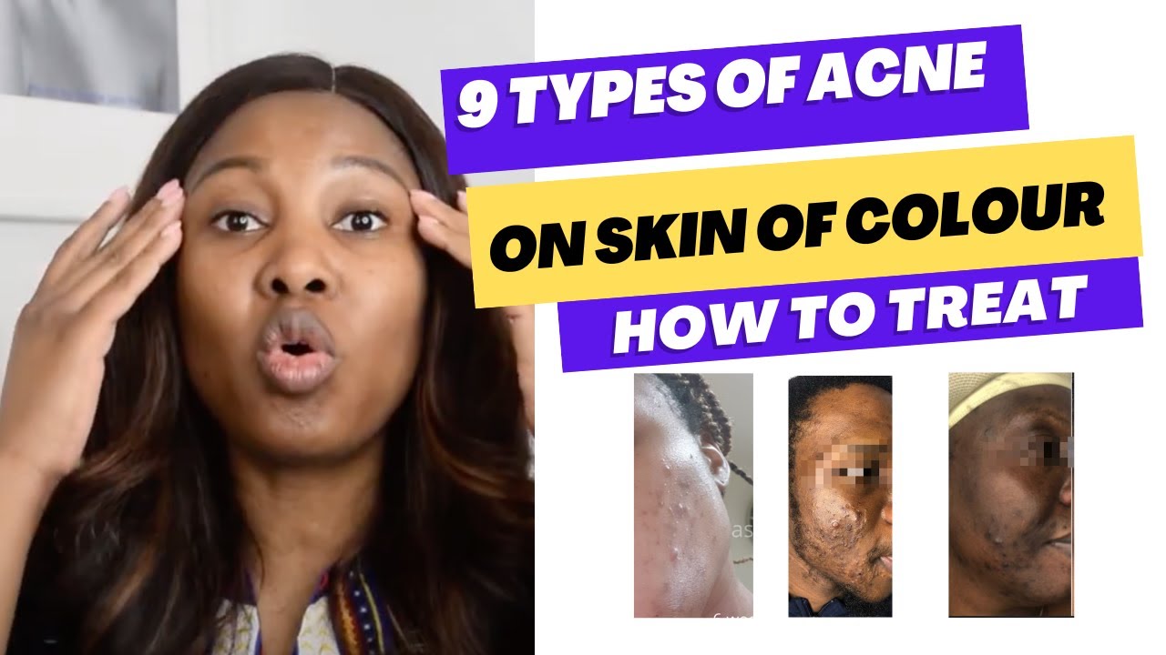 9 Types Of Acne In Skin Of Color - how to treat #skinofcolour # ...