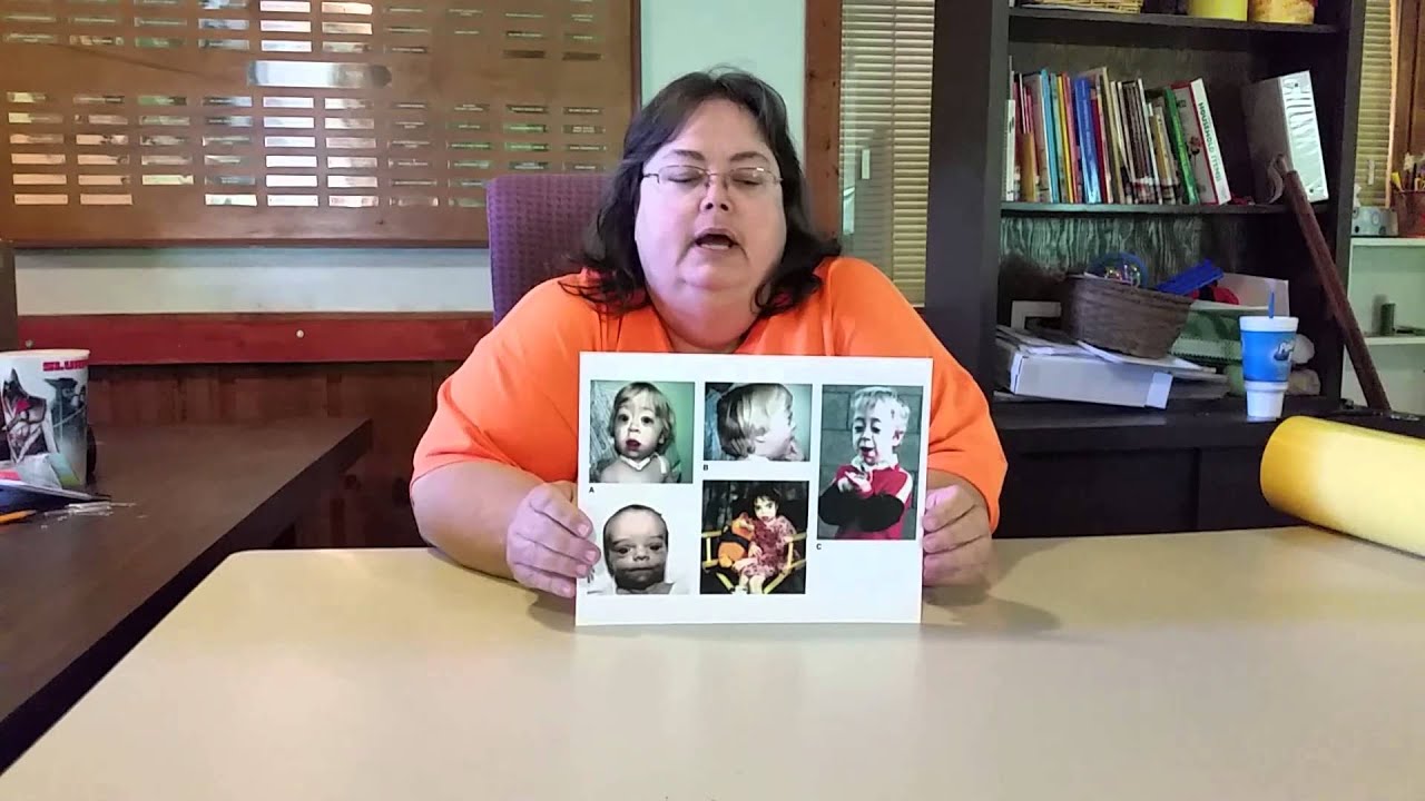 Marshall Smith Syndrome PSC project - YouTube