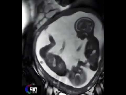 Unborn Twins fighting caught on Video MRI 😂 - YouTube