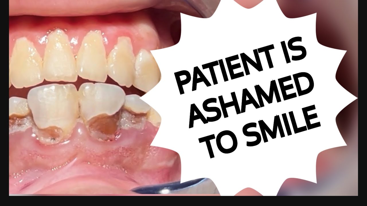 Making the Patient Smile Confidently Again. Big cavities in his front ...
