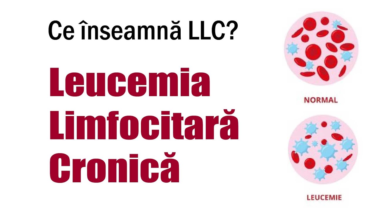 Ce inseamna Leucemia Limfocitara Cronica? LLC #cancer - YouTube