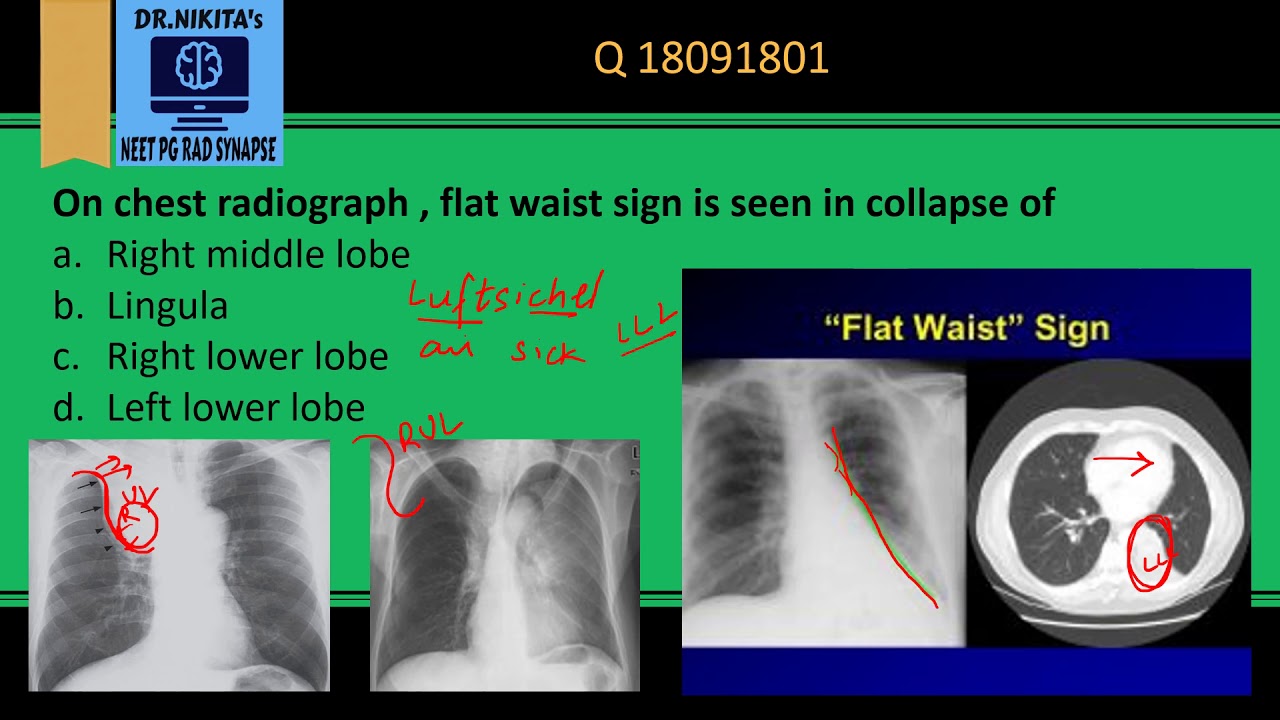Flat waist sign/ Golden S sign/ Luftsichel sign - YouTube