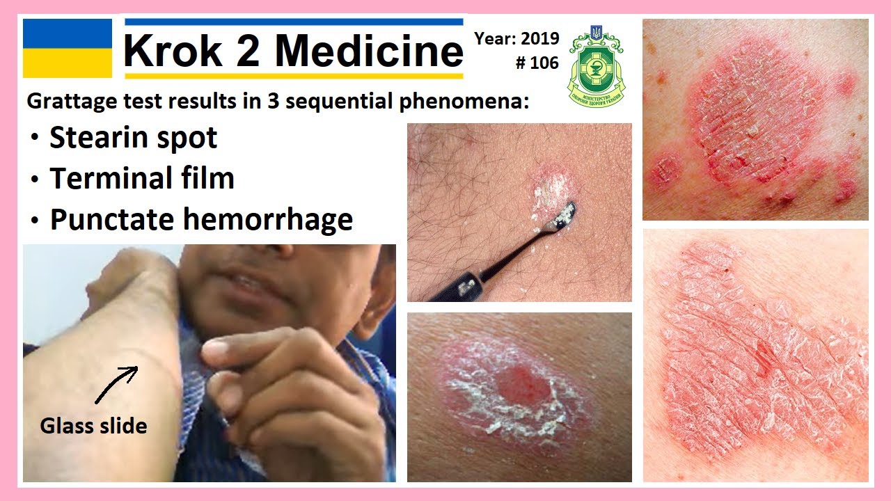 [ Krok 2 Medicine ] Year: 2019 - 106 (Ministry of Public Health of ...