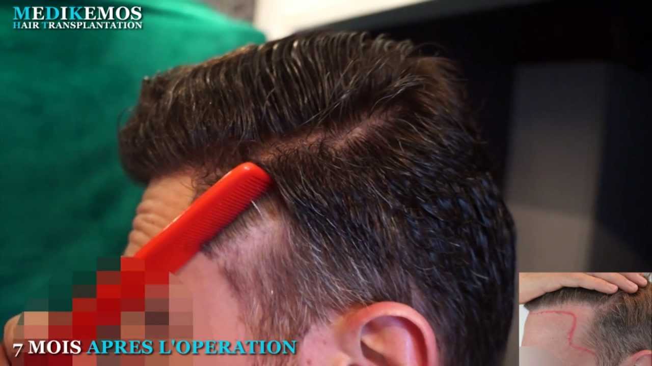 FUE 2867 et 2675 UFs MeDiKemos Hair Transplantation FR - YouTube
