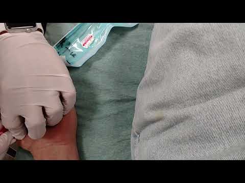 Splinter removal - YouTube