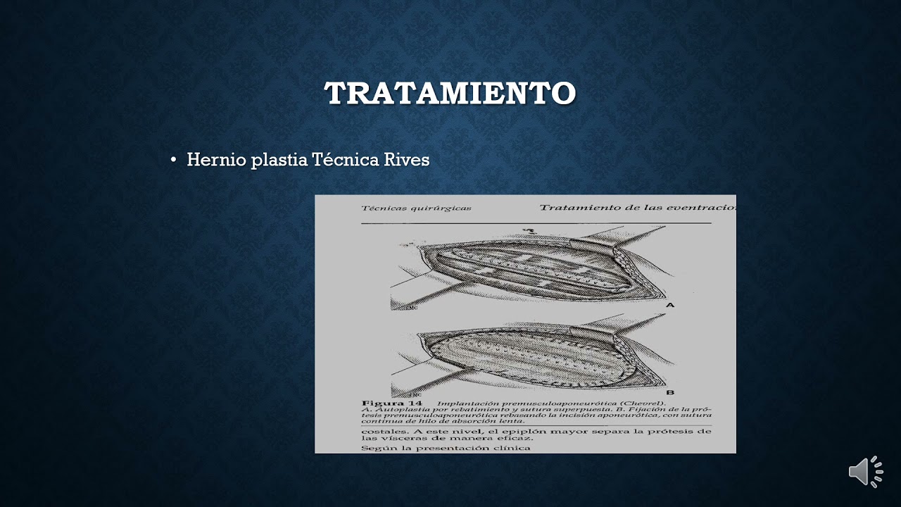 Hernia post incisional , dehiscencia y evisceración - YouTube