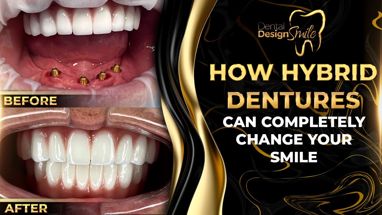 How Hybrid Dentures Can Completely Change Your Smile - YouTube