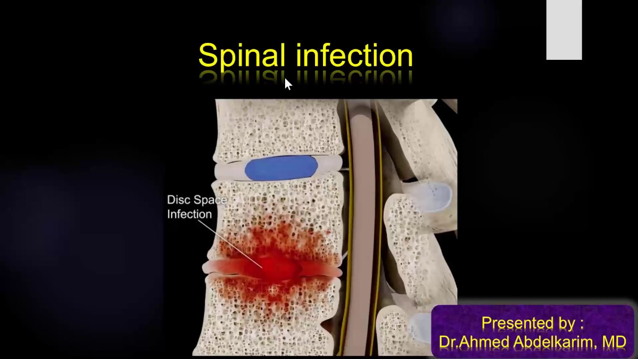 spinal infection - YouTube